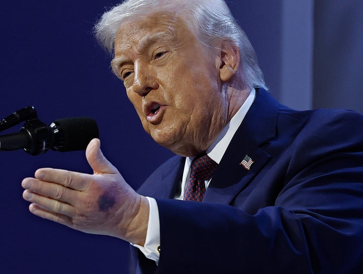 Donald Trump Has Yet Another Hand Bruise -- And A Sketchy Excuse ...