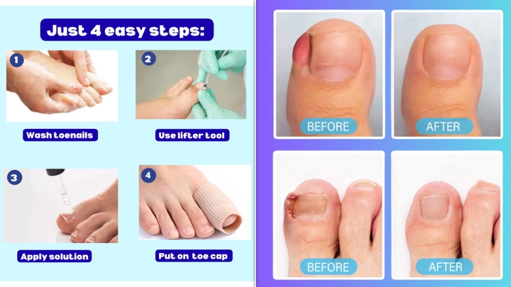 This $20 Ingrown Toenail Kit Could Save You From Days Of Pain ...